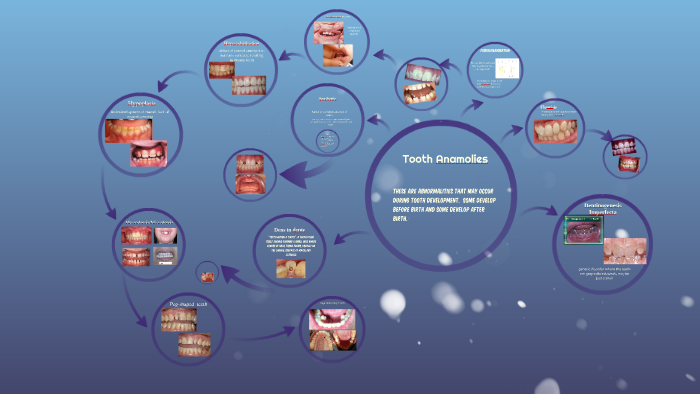 Tooth Anamolies by Debra Bothel on Prezi