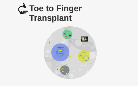 Toe to Finger Transplant by Tessa Runer on Prezi