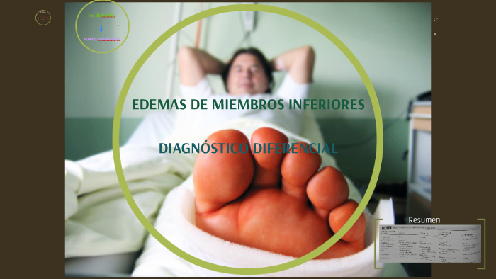 EDEMAS DE MIEMBROS INFERIORES by Grupo3b 3b on Prezi