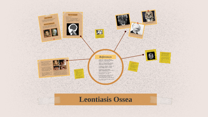 Leontiasis Ossea by Leilani Connolly on Prezi