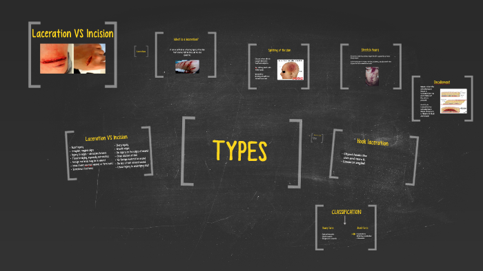 Laceration VS Incision by Nicola van Zyl on Prezi