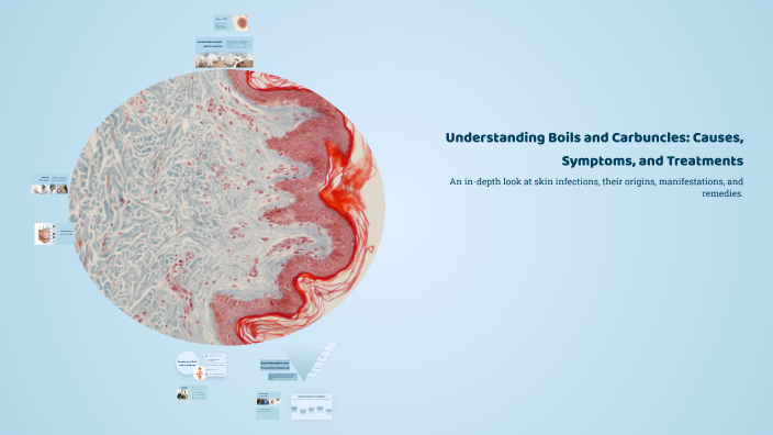 Understanding Boils and Carbuncles: Causes, Symptoms, and Treatments by ...