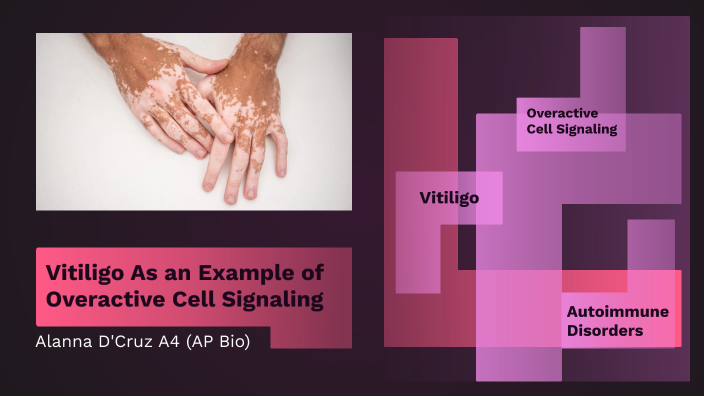 Vitiligo - Examples of Autoimmune disorders and Overactive Cell ...