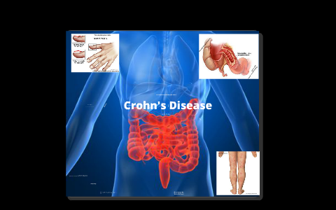 Chrones Disease by God Evans