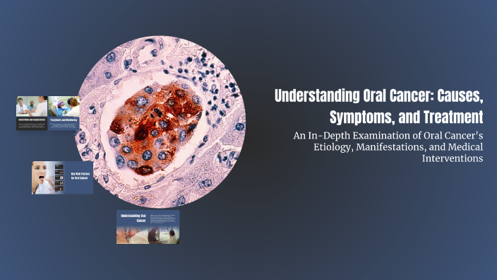 Understanding Oral Cancer: Causes, Symptoms, and Treatment by Johnna ...
