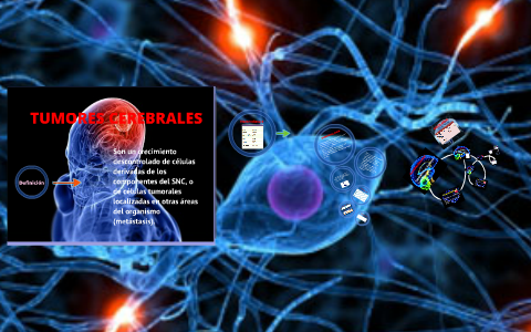 Tumores Supratentoriales by Miguel Macias on Prezi
