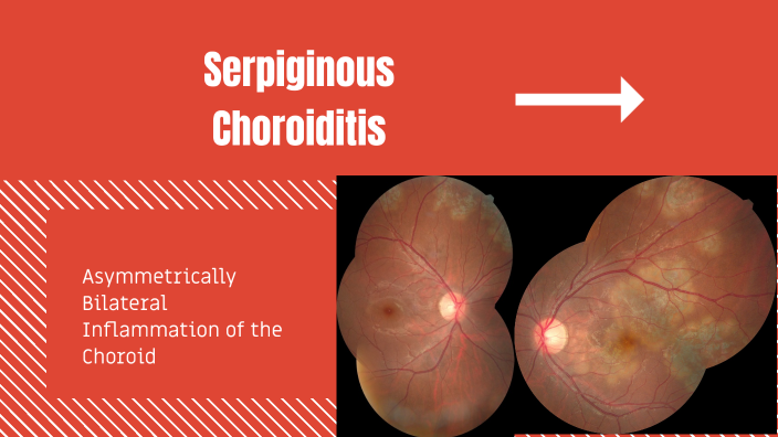 Decoding the Enigma of Serpiginous Choroiditis by Kshitij Raizada on Prezi