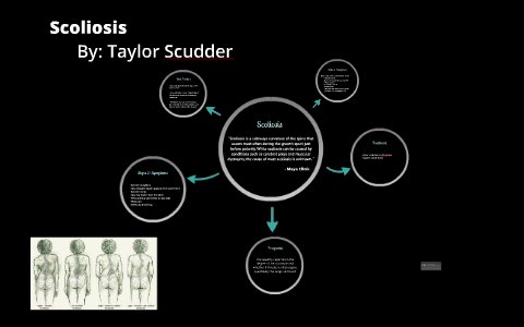 Scoliosis by Taylor Scudder on Prezi