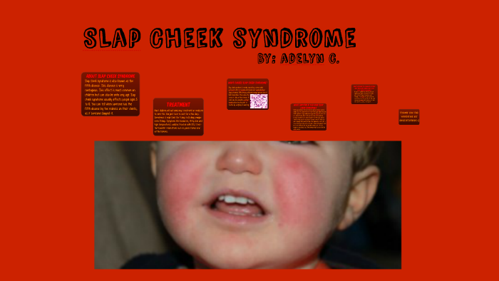 Slap Cheek syndrome by Adelyn Choy on Prezi