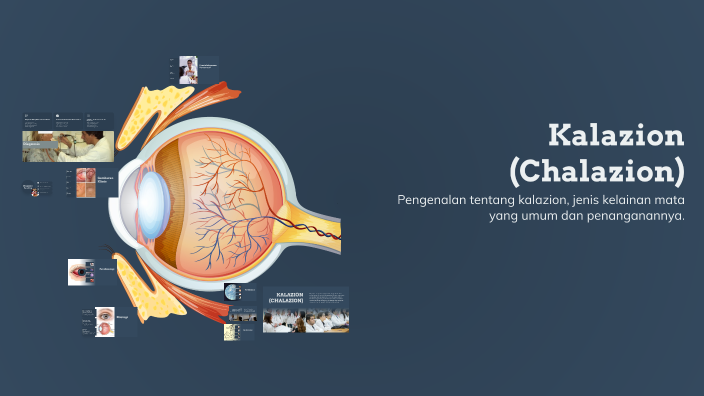 Kalazion (Chalazion) by Shadiq S3 on Prezi