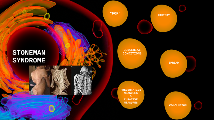 Stoneman Syndrome by Yamile Perez on Prezi