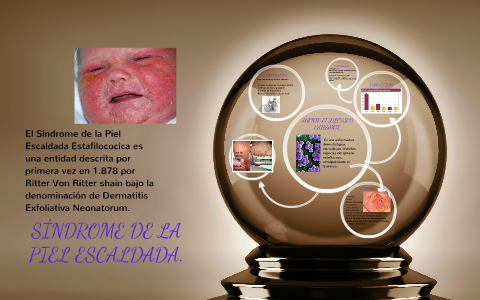 SÍNDROME DE LA PIEL ESCALDADA. by maria victoria lozano gomez on Prezi