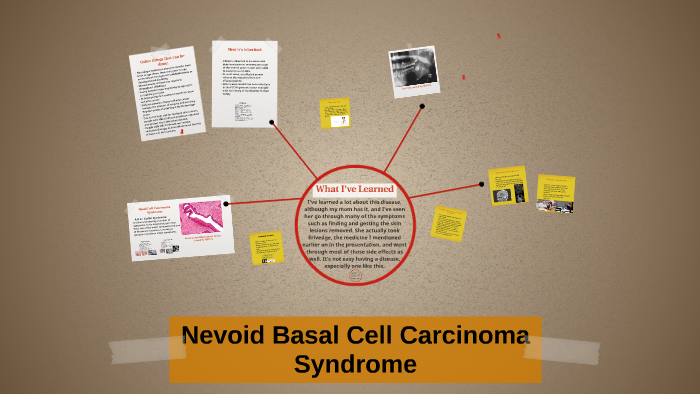 Nevoid Basal Cell Carcinoma Syndrome by Kayla Walker on Prezi