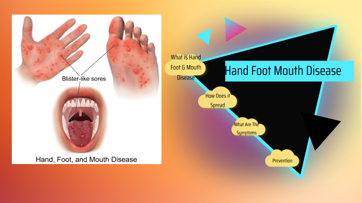 Hand, Foot, Mouth Disease by Kierra Elliott on Prezi