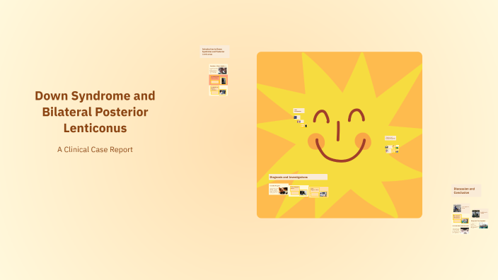 Down Syndrome and Bilateral Posterior Lenticonus by Humberto ...