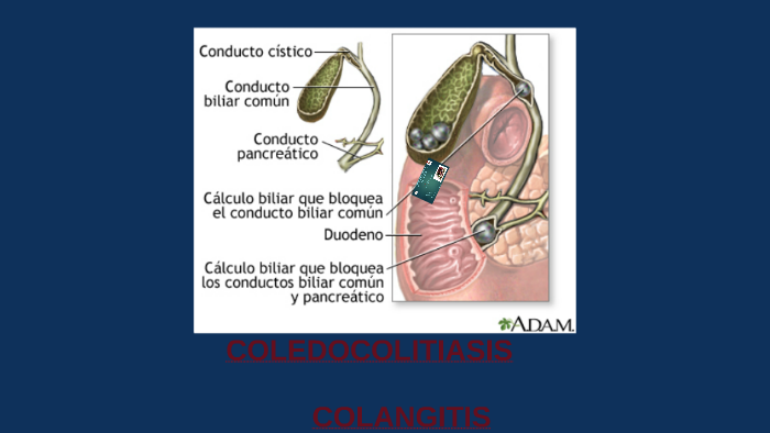 COLEDOCOLITIASIS – COLANGITIS by Joselyn Jimenez on Prezi