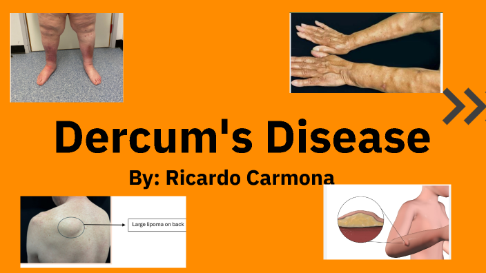 Dercum's Disease by Christian Alvarez on Prezi
