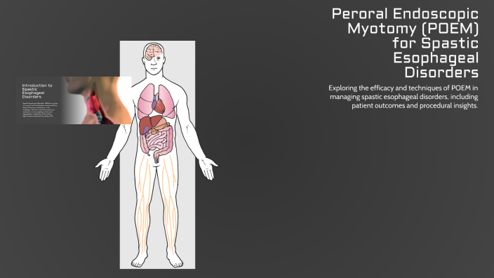 Peroral Endoscopic Myotomy (POEM) for Spastic Esophageal Disorders by ...