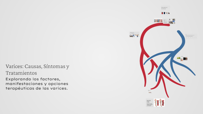 Varices: Causas, Síntomas y Tratamientos by Tere Plascencia on Prezi