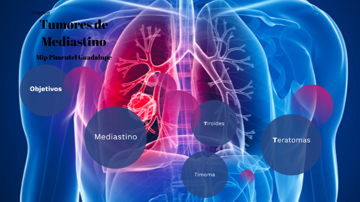 Tumores de mediastino by Equipo2 infectologia on Prezi