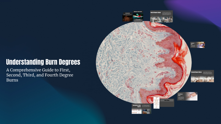 Understanding Burn Degrees by Matthew Shefl on Prezi
