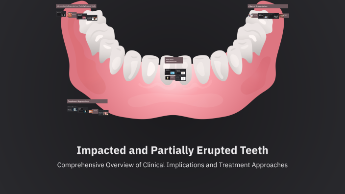 Impacted and Partially Erupted Teeth by Lucas on Prezi