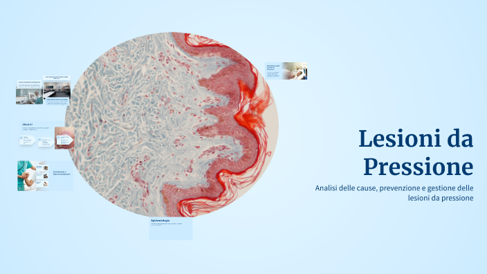 Lesioni da Pressione by Valerio Sgrigna on Prezi