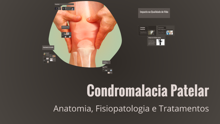 Condromalacia Patelar by Vitor Formigoni on Prezi