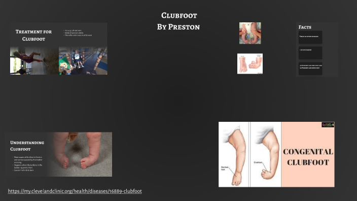 Understanding Clubfoot: Causes, Treatment, and Management by PRESTON ...