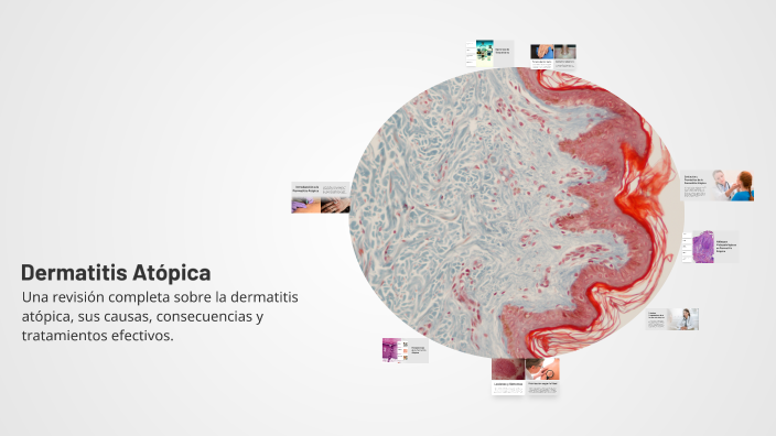 Dermatitis Atópica by Juan Ignacio Puig on Prezi