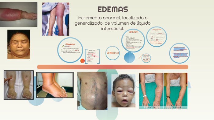 EDEMAS by Maria Ludmila Rivera on Prezi