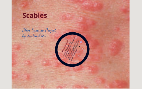 Scabies - Human Anatomy by Justin Lien on Prezi