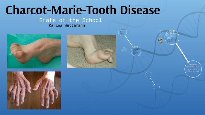 Charcot-Marie-Tooth by Karina Wettemann on Prezi