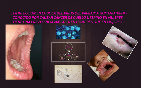 LA INFECCIÓN EN LA BOCA DEL VIRUS DEL PAPILOMA HUMANO (VPH) by jenny ...