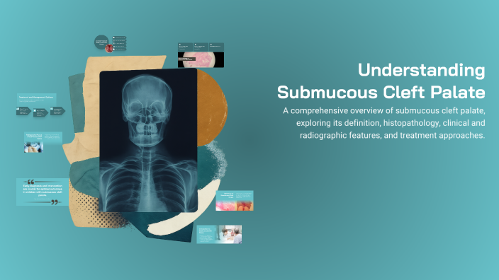 Understanding Submucous Cleft Palate by Hisham Magdy on Prezi