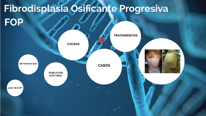 ENFERMEDAD FOP by juan zabaleta on Prezi