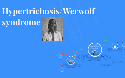 Hypertrichosis (WereWolf syndrome) by hunter montoya on Prezi