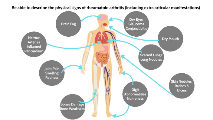 Be able to describe the physical signs of rheumatoid arthritis ...