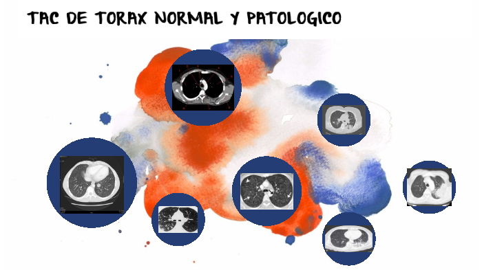 TAC DE TORAX NORMAL Y PATOLOGICO by LUZ CAMPOVERDE LIMONES on Prezi