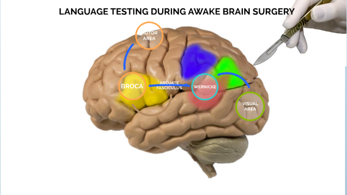 Language testing during awake brain surgery by Julie Balan on Prezi