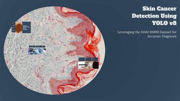 Skin Cancer Detection Using YOLO v8 by Siddharth Plain on Prezi