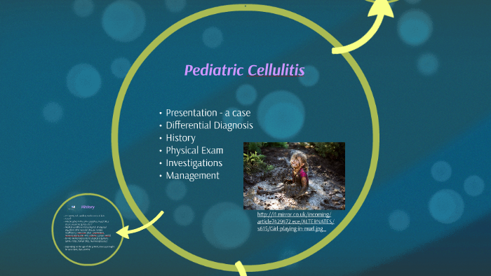 Pediatric Cellulitis by Anna Redekop on Prezi