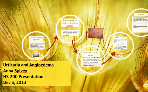 Urticaria by Anna Spivey on Prezi