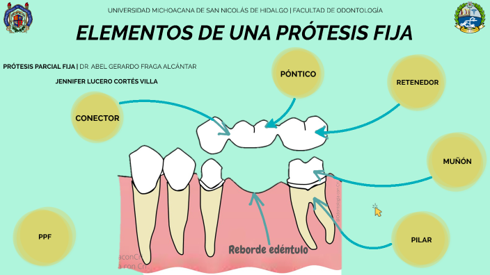ELEMENTOS DE UNA PRÓTESIS PARCIAL FIJA by Jennifer Lucero Cortes Villa ...