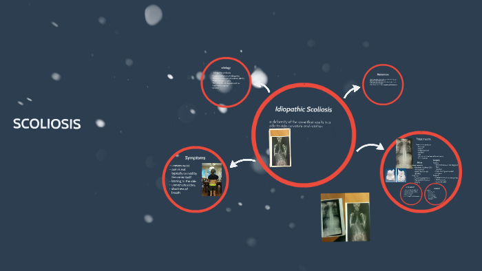 Idiopathic Scoliosis by Madison Gilliam on Prezi