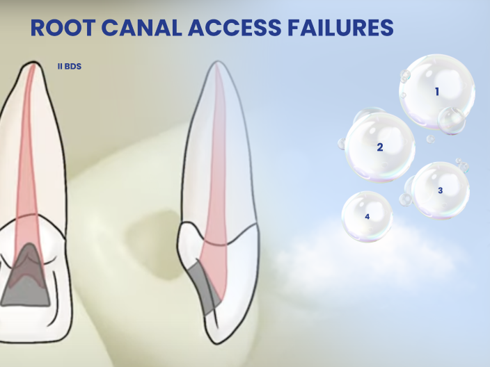 ROOT CANAL ACCESS FAILURES by yohan chacko on Prezi