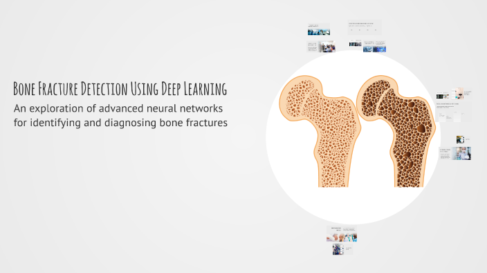 Bone Fracture Detection Using Deep Learning by khushi wagh on Prezi