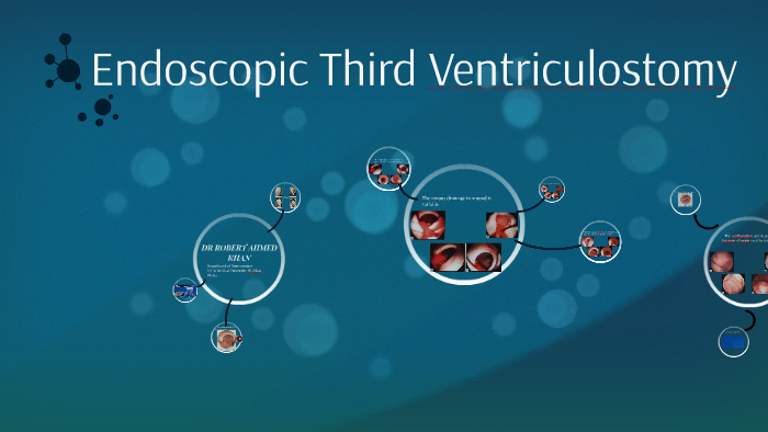 Endoscopic Third Ventriculostomy by Robert Khan on Prezi