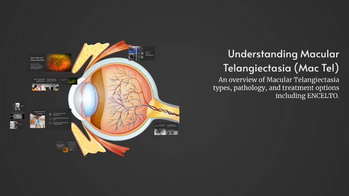 Understanding Macular Telangiectasia (Mac Tel) by BHAVYA YARLAGADDA ...