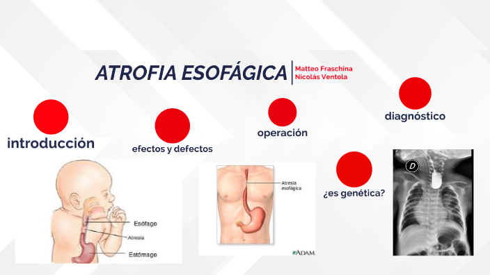 ATROFIA ESOFAGICA by matteo fraschina on Prezi